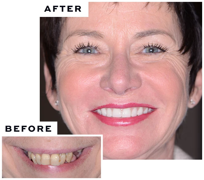 Dental Implants in Miami, Florida | Dr. Hines – Change Your Smile & Life